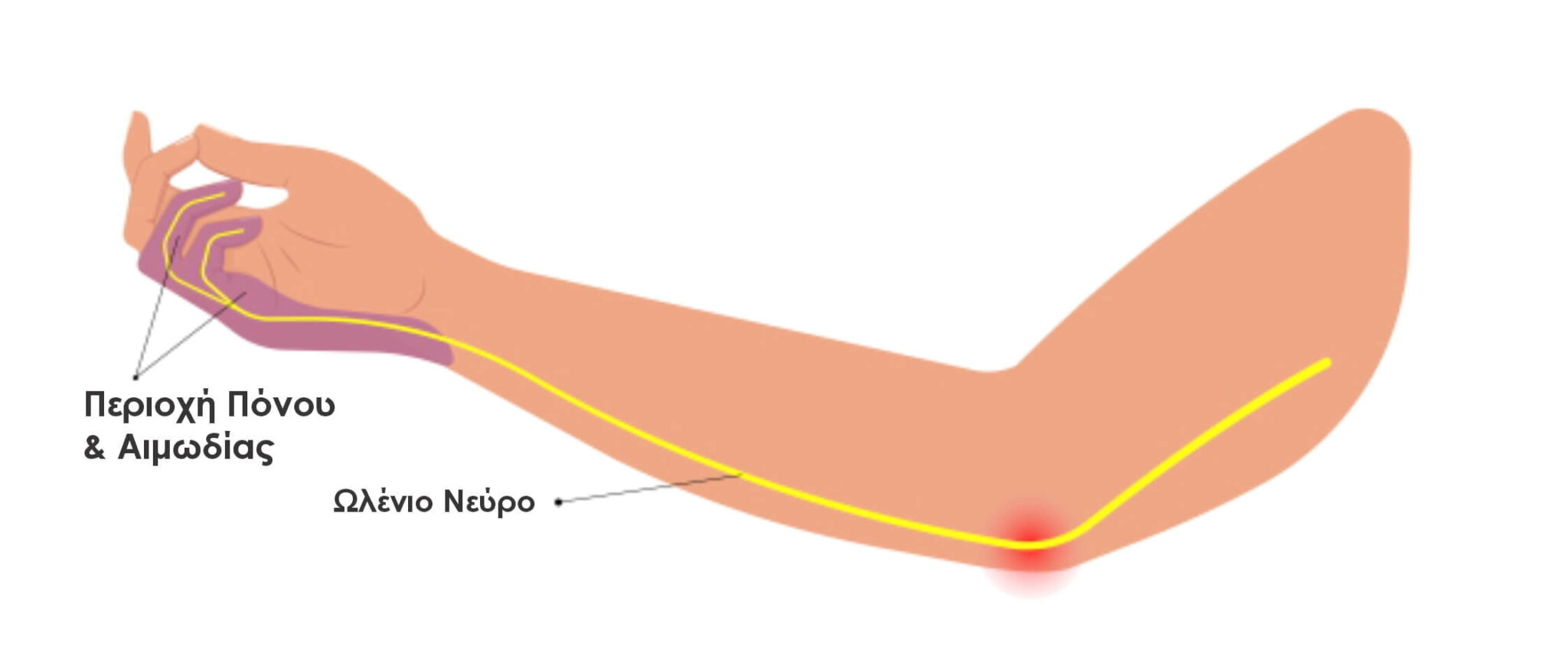 Ωλένια Νευρίτιδα και Φυσικοθεραπεία - Ε. Γεωργακόπουλος