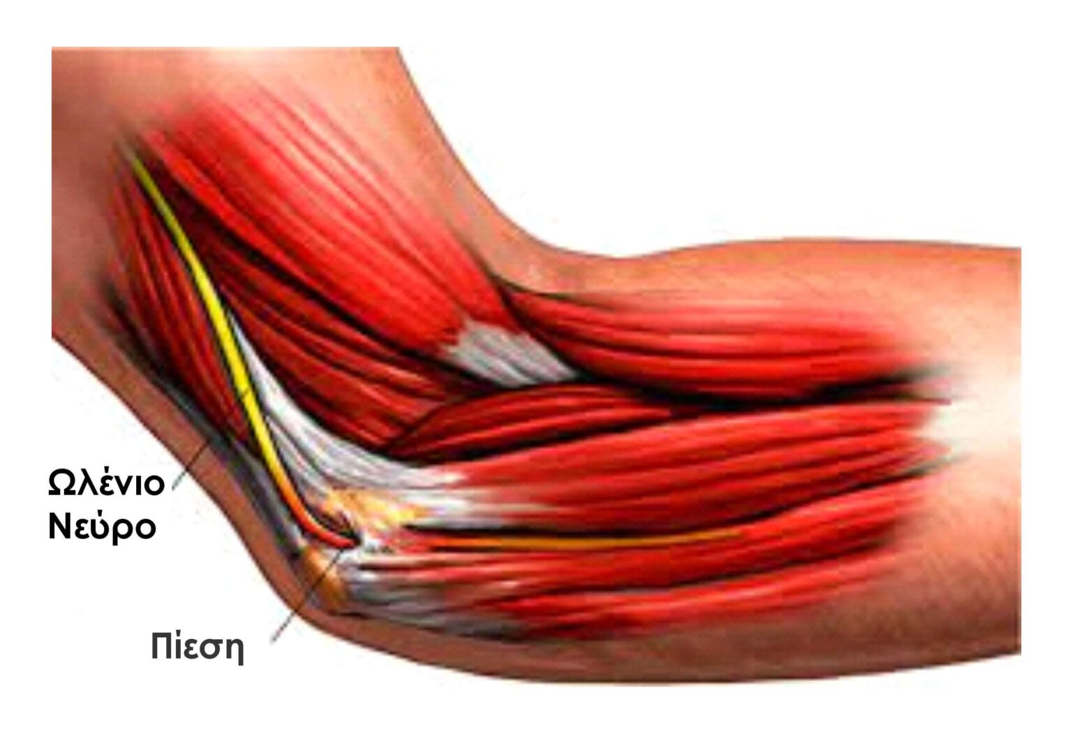 Ωλένια Νευρίτιδα και Φυσικοθεραπεία - Ε. Γεωργακόπουλος